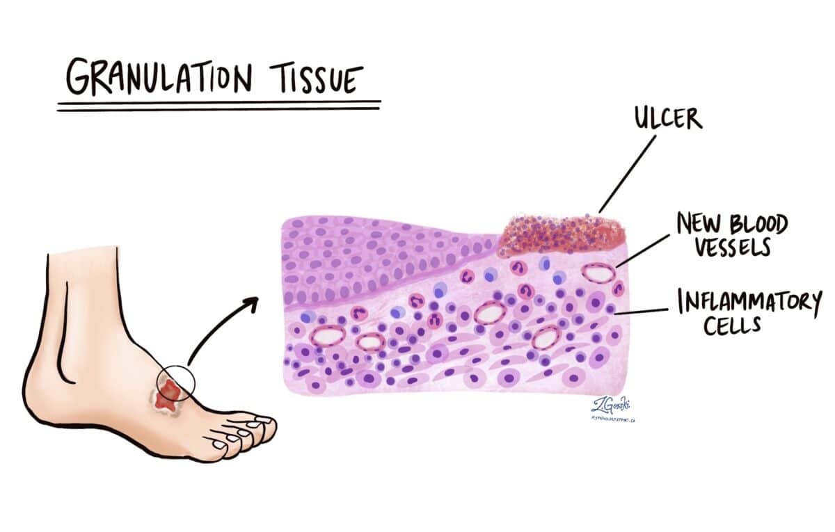 Granulation Tissue: The Key Indicator of Proper Wound Healing | Healogics